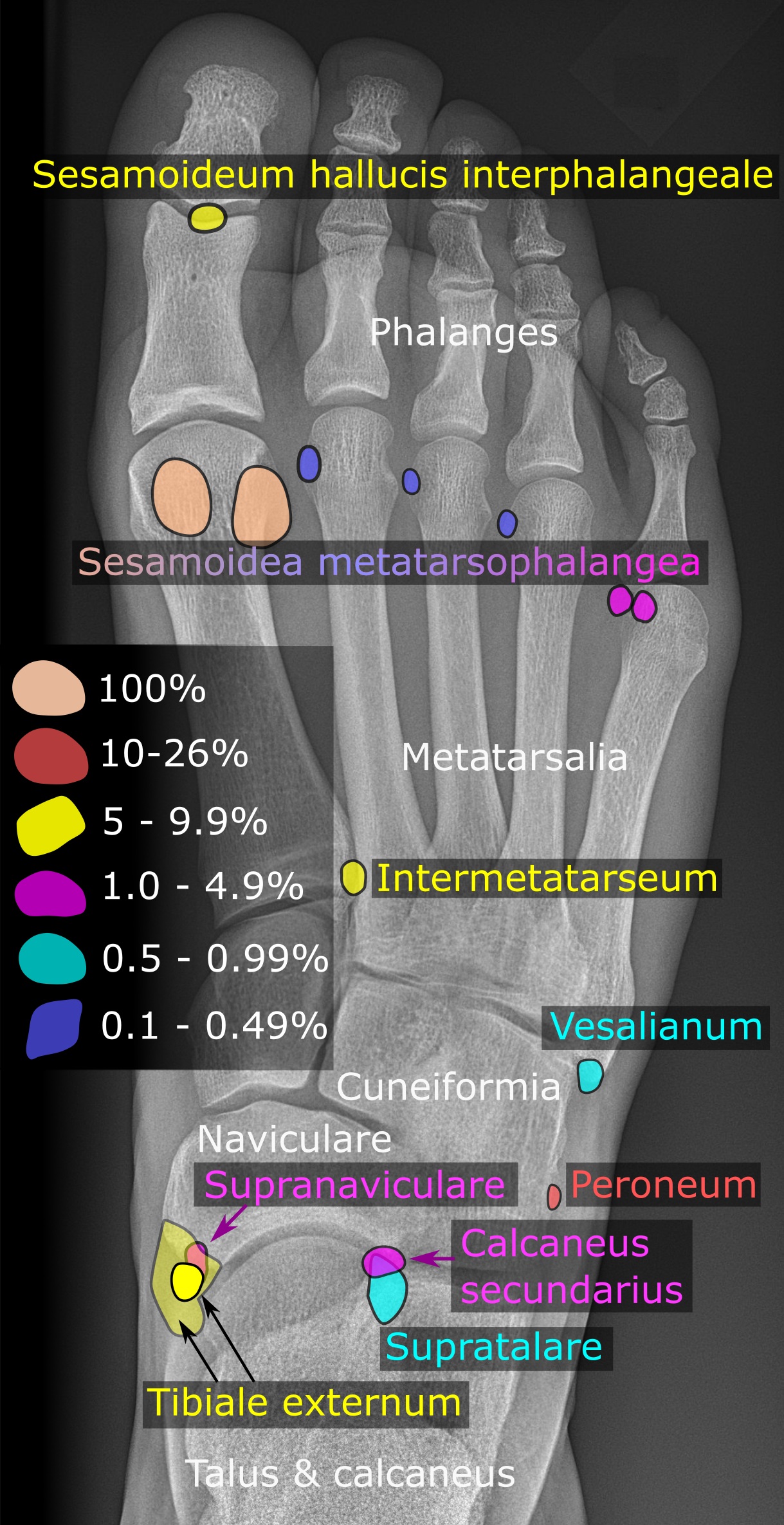 Intertarsalarthrose Fuß